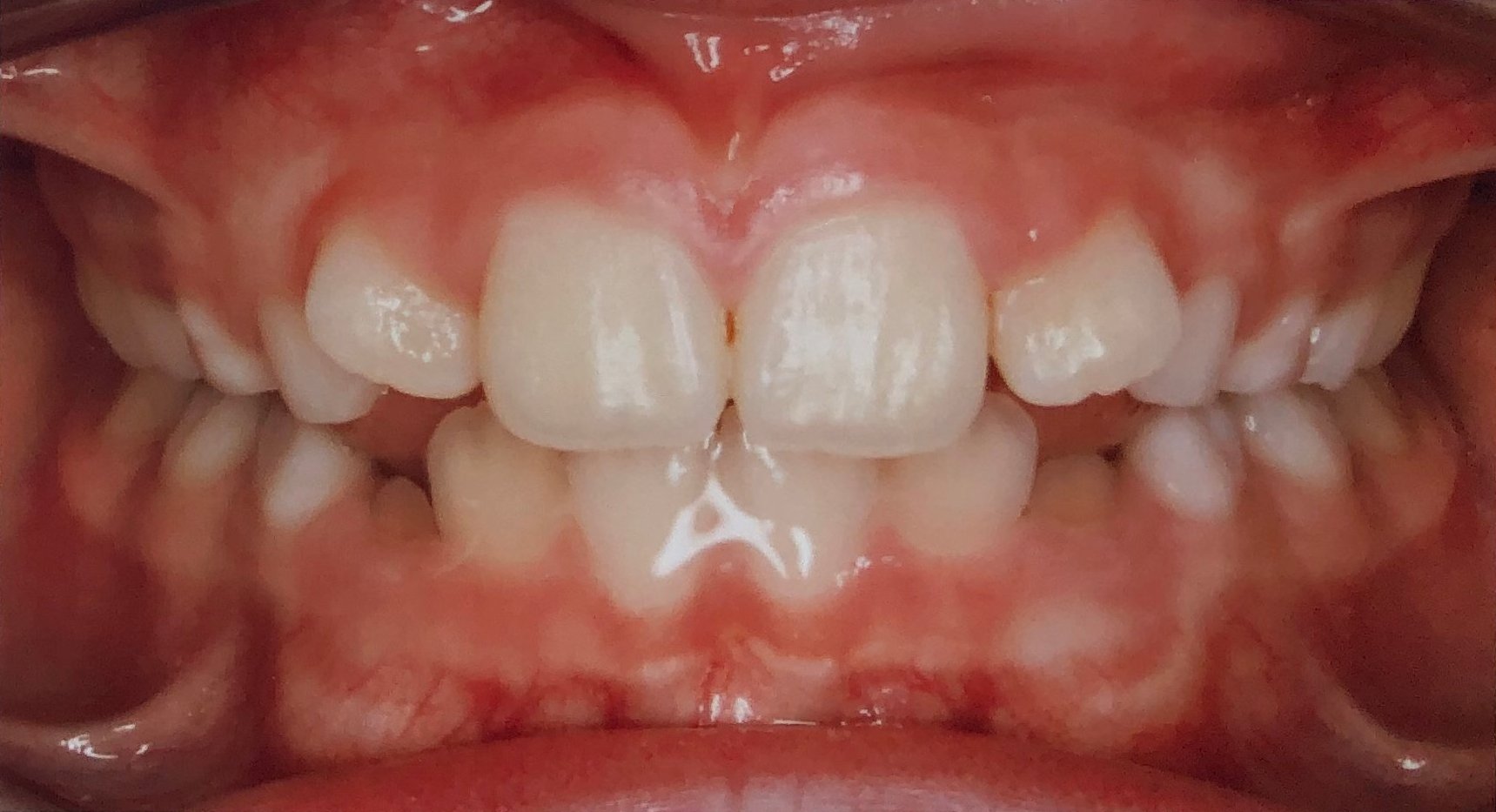 Fix Overbite, Gaps & Crowded Teeth in Burlingame - San Bruno - Hillsborough